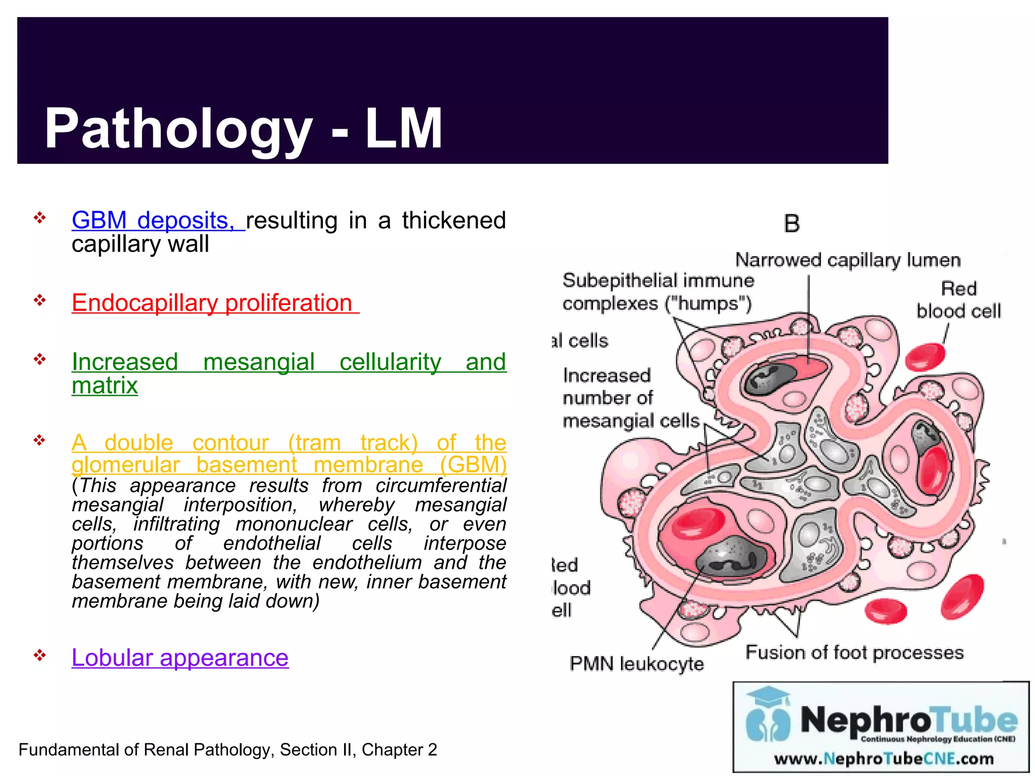 Membranoproliferative GN - Road to Diagnosis & Management - What is the ...