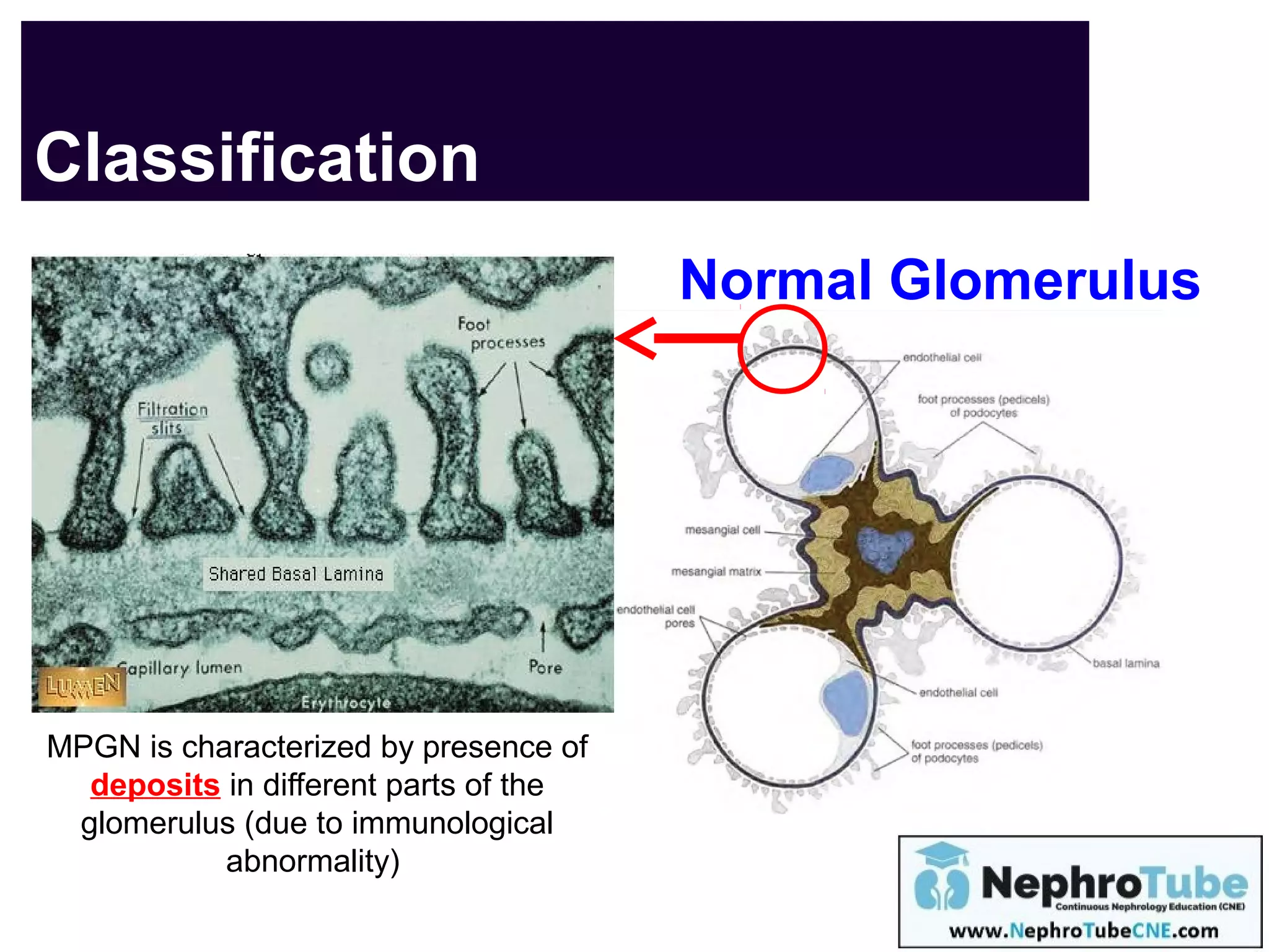 Membranoproliferative GN - Road to Diagnosis & Management - What is the ...