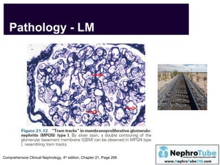 Membranoproliferative Glomerulonephritis Tram Track