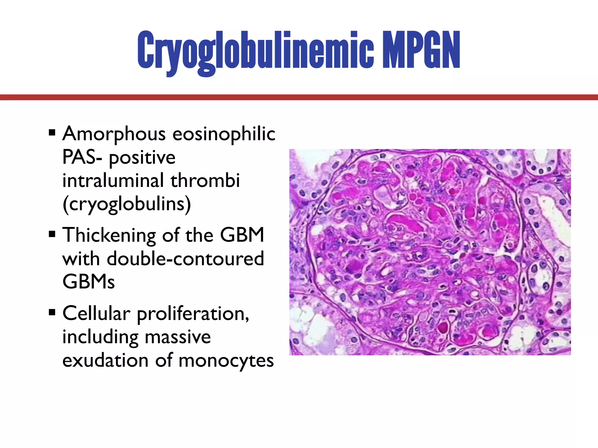 Membranoproliferative Glomerulonephritis MPGN chaken | PPT