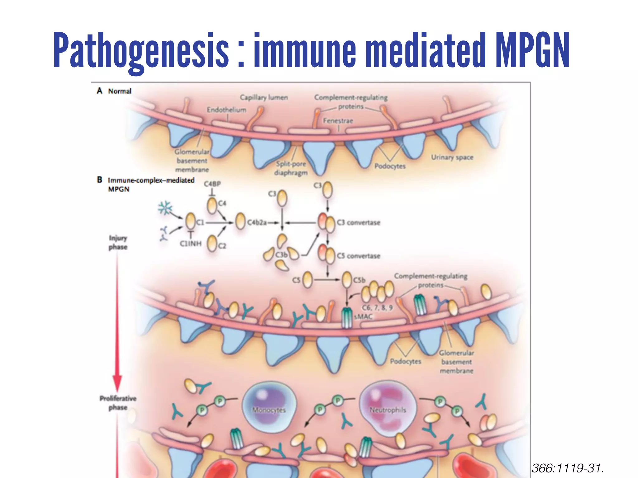 Membranoproliferative Glomerulonephritis MPGN chaken | PPT