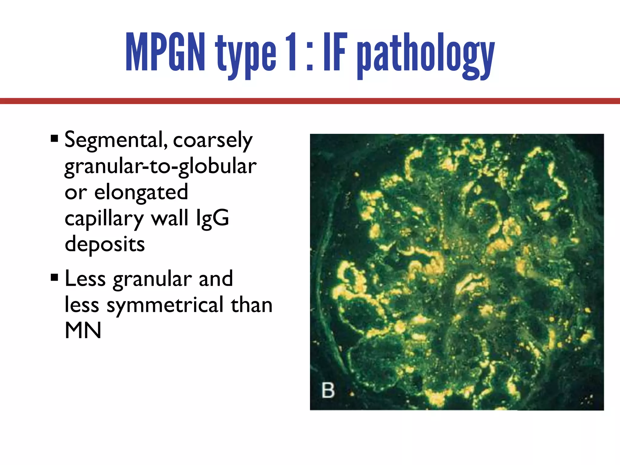 Membranoproliferative Glomerulonephritis MPGN chaken | PDF
