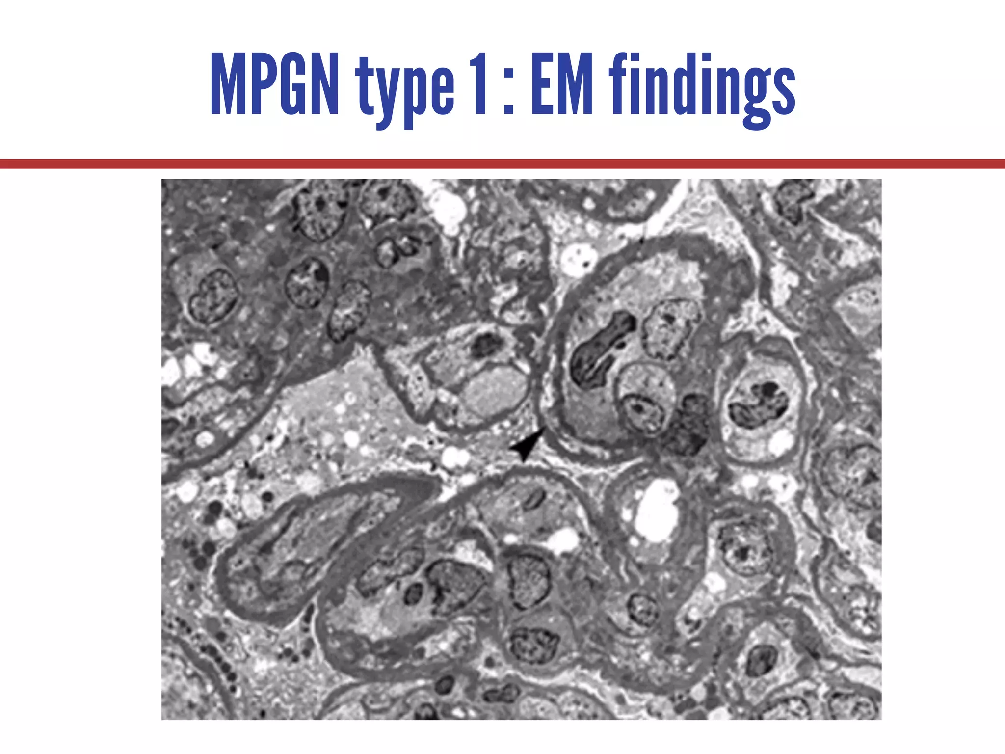 Membranoproliferative Glomerulonephritis MPGN chaken | PPT