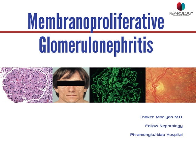 Membranoproliferative Glomerulonephritis MPGN chaken | PPT