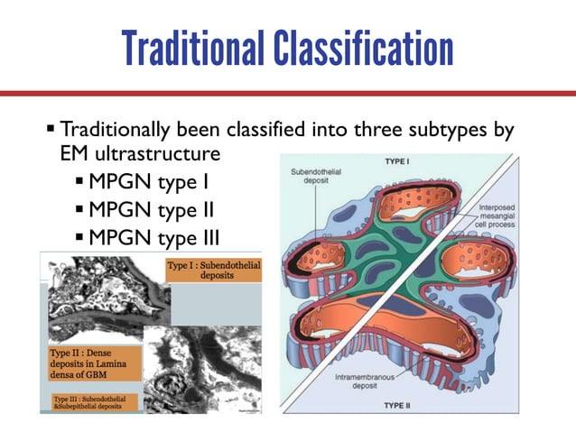 Membranoproliferative Glomerulonephritis MPGN chaken | PPT