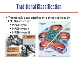 Membranoproliferative Glomerulonephritis Type 2