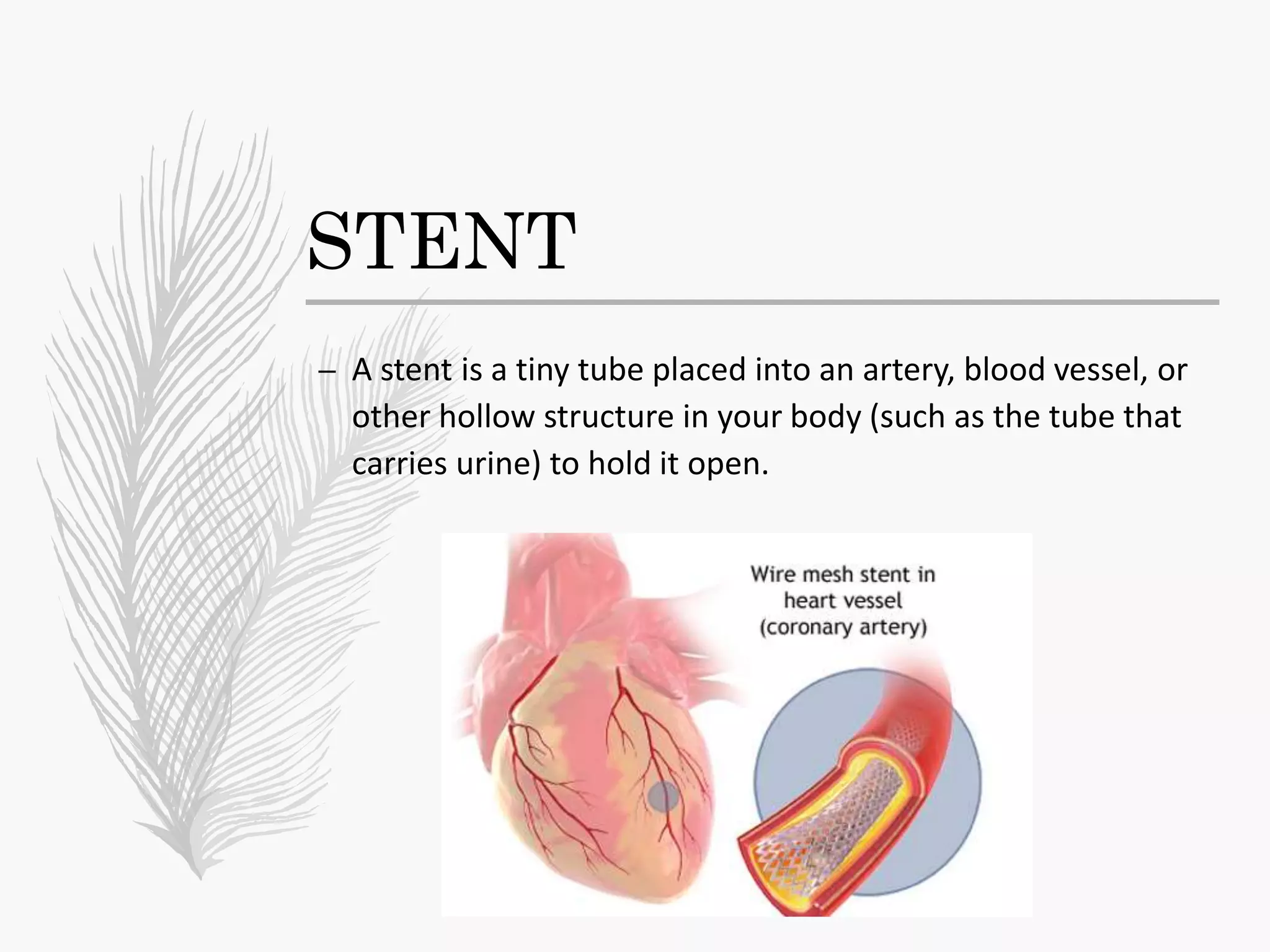 Manufacturing of stents | PPT