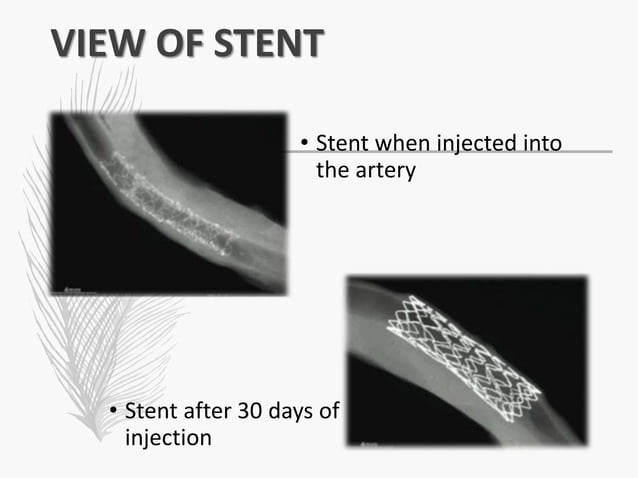 Manufacturing of stents | PPT