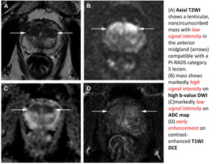 MP MRI PROSTATE.pptx