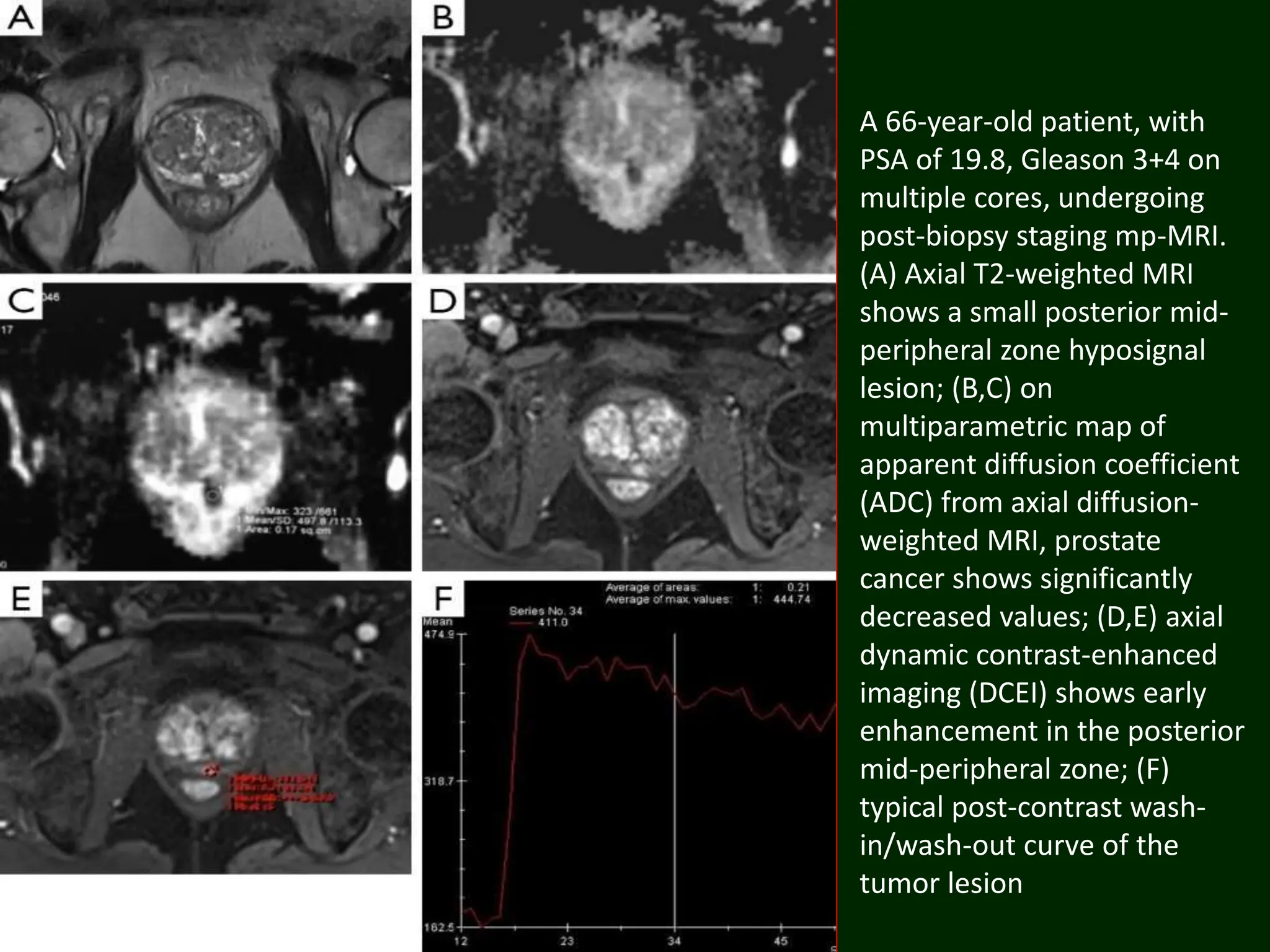MP MRI of prostate by Major Imran from BD.pptx