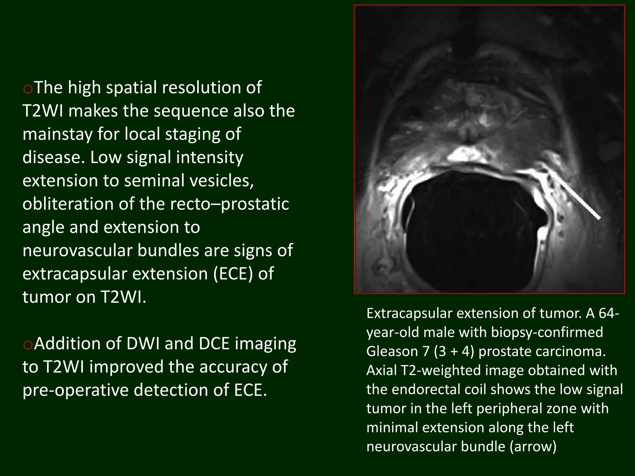 MP MRI of prostate by Major Imran from BD.pptx
