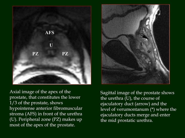 MP MRI of prostate by Major Imran from BD.pptx