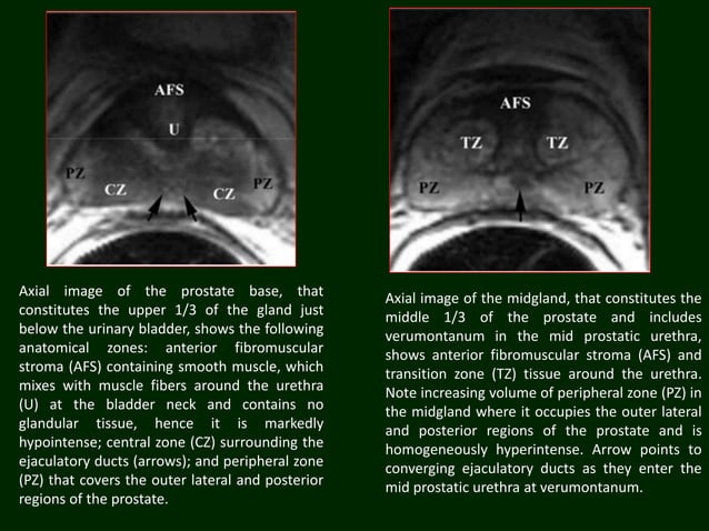 MP MRI of prostate by Major Imran from BD.pptx
