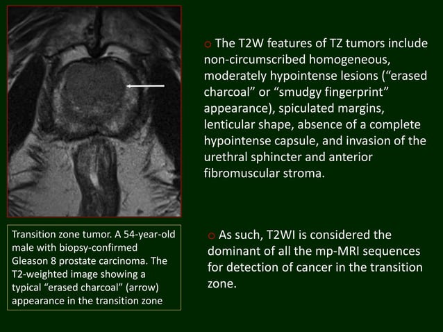 MP MRI of prostate by Major Imran from BD.pptx