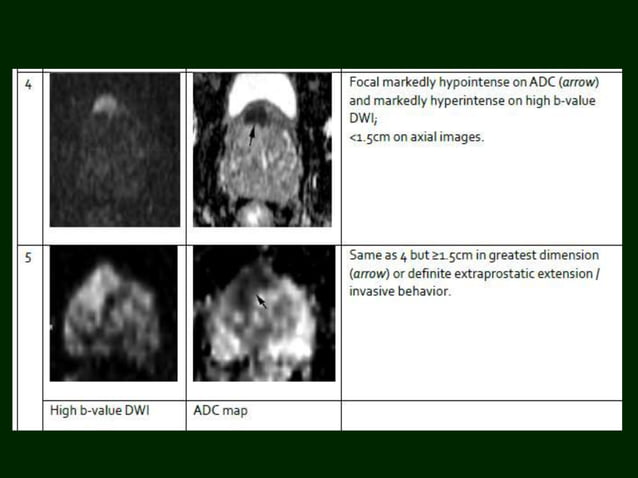 MP MRI of prostate by Major Imran from BD.pptx