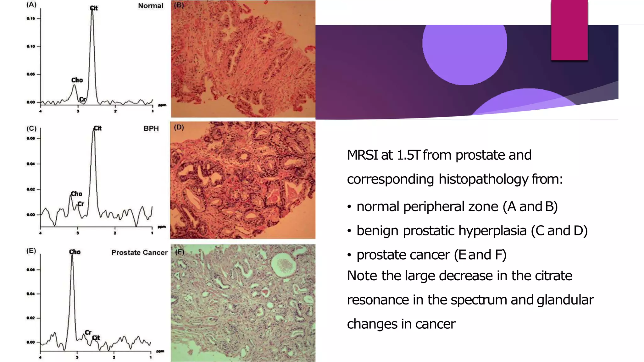 Mp mri seminar uro | PPT