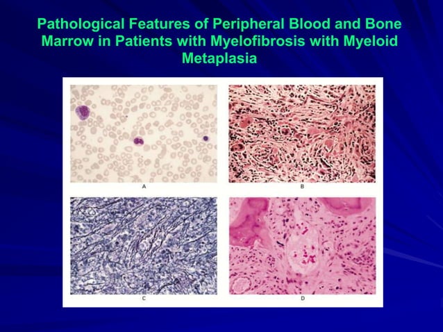 Myeloproliferative disorders.ppt