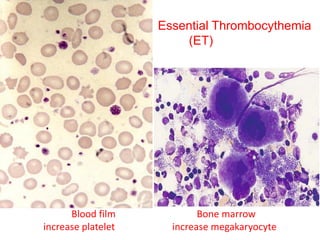 MPNs; Definition, Types of MPN Mutations, Aetiology, Clinical features ...