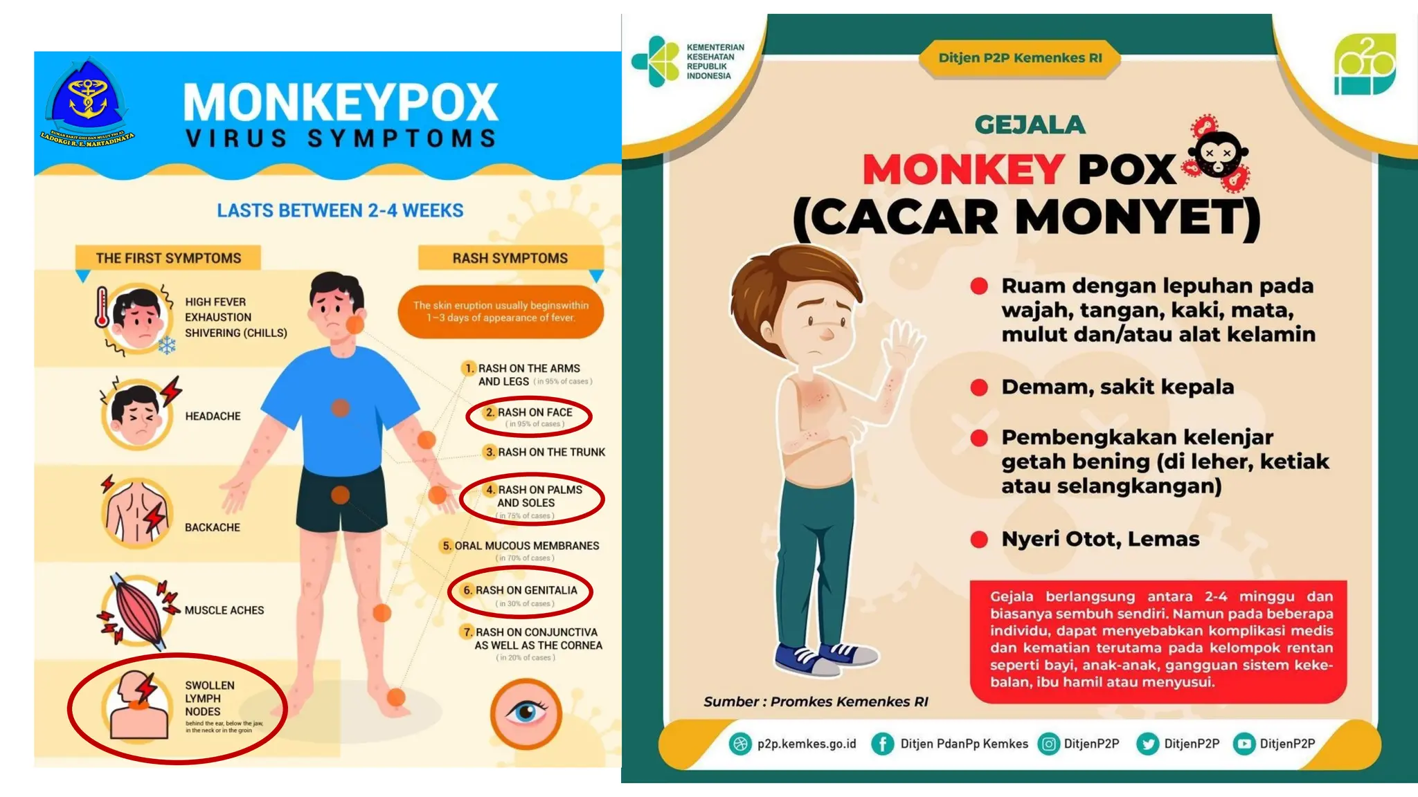 Monkey Pox adalah virus yang menyerang hewan | PPT