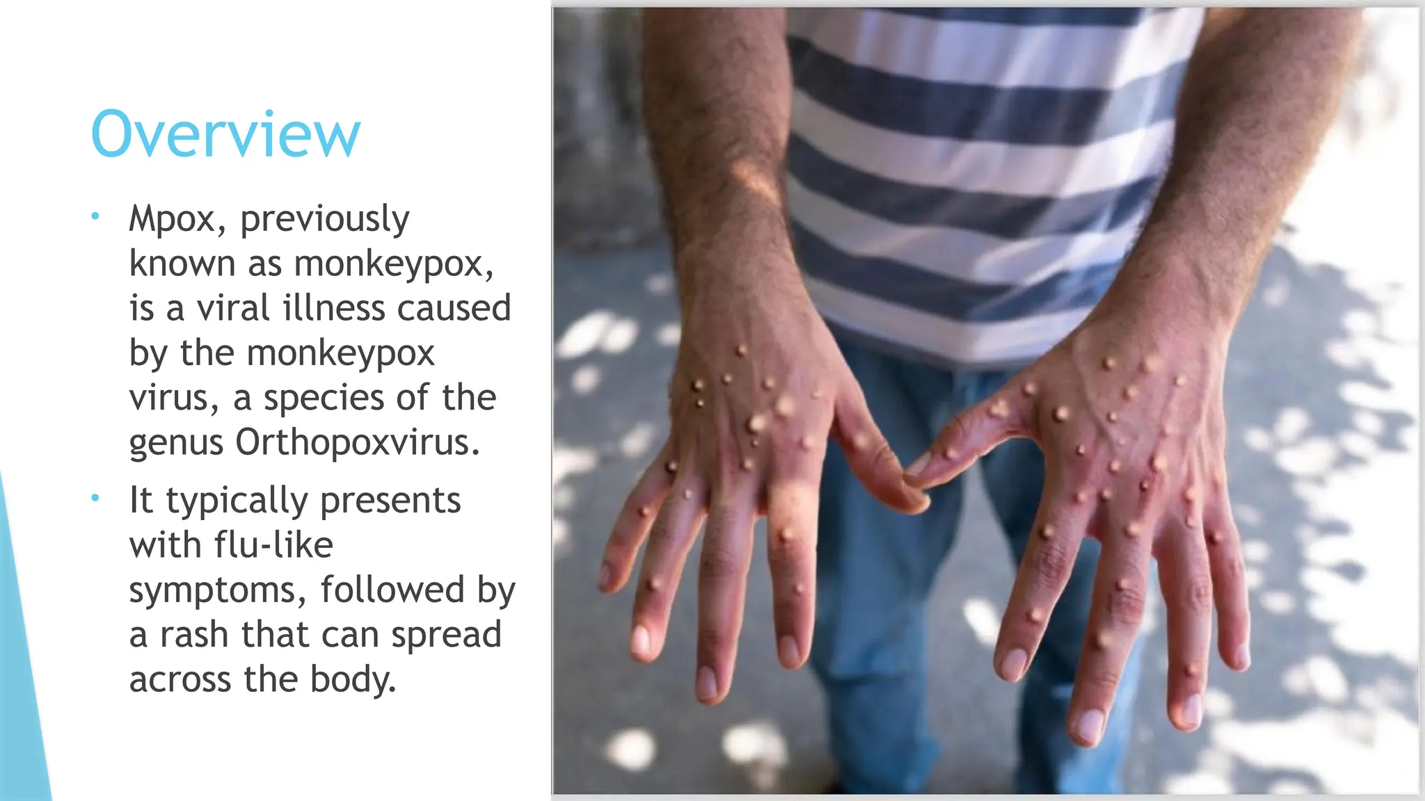 Monkey PoX disease overview and management.pptx