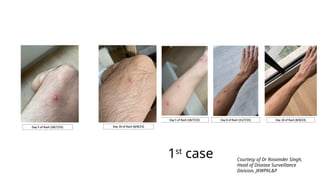 Mpox vs other common rash MONKEY POX AND RASHES | PPTX