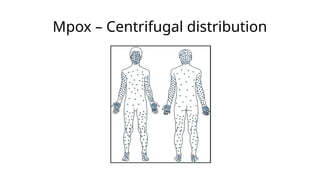 Mpox vs other common rash MONKEY POX AND RASHES | PPTX