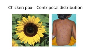Mpox vs other common rash MONKEY POX AND RASHES | PPTX
