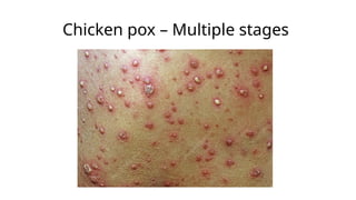 Mpox vs other common rash MONKEY POX AND RASHES | PPT