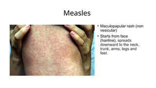 Mpox vs other common rash MONKEY POX AND RASHES | PPTX