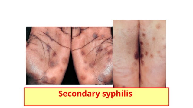 Mpox vs other common rash MONKEY POX AND RASHES | PPT