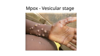 Mpox vs other common rash MONKEY POX AND RASHES | PPTX
