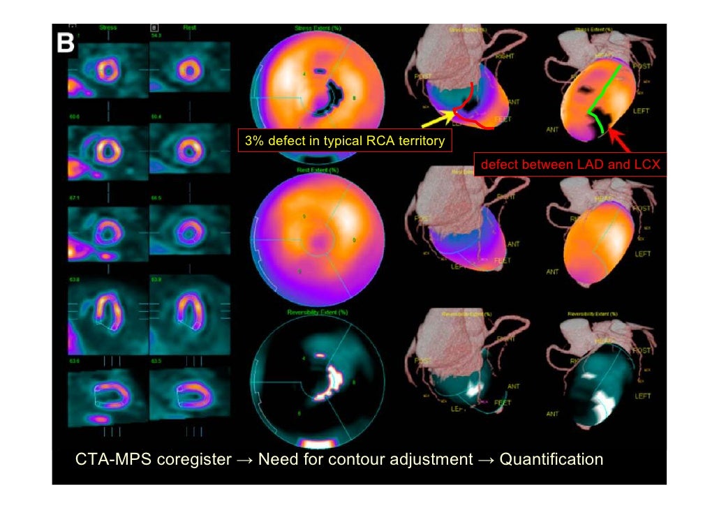 Myocardial Perfusion SPECT coregistered Coronary CTA