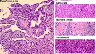 malignant neoplasm of the peritoneum | PPT
