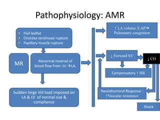 Mitral regurgitation | PPTX