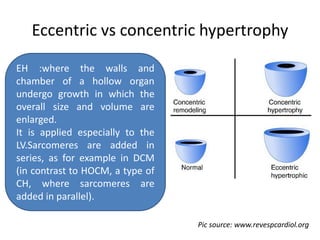 Mitral regurgitation | PPTX