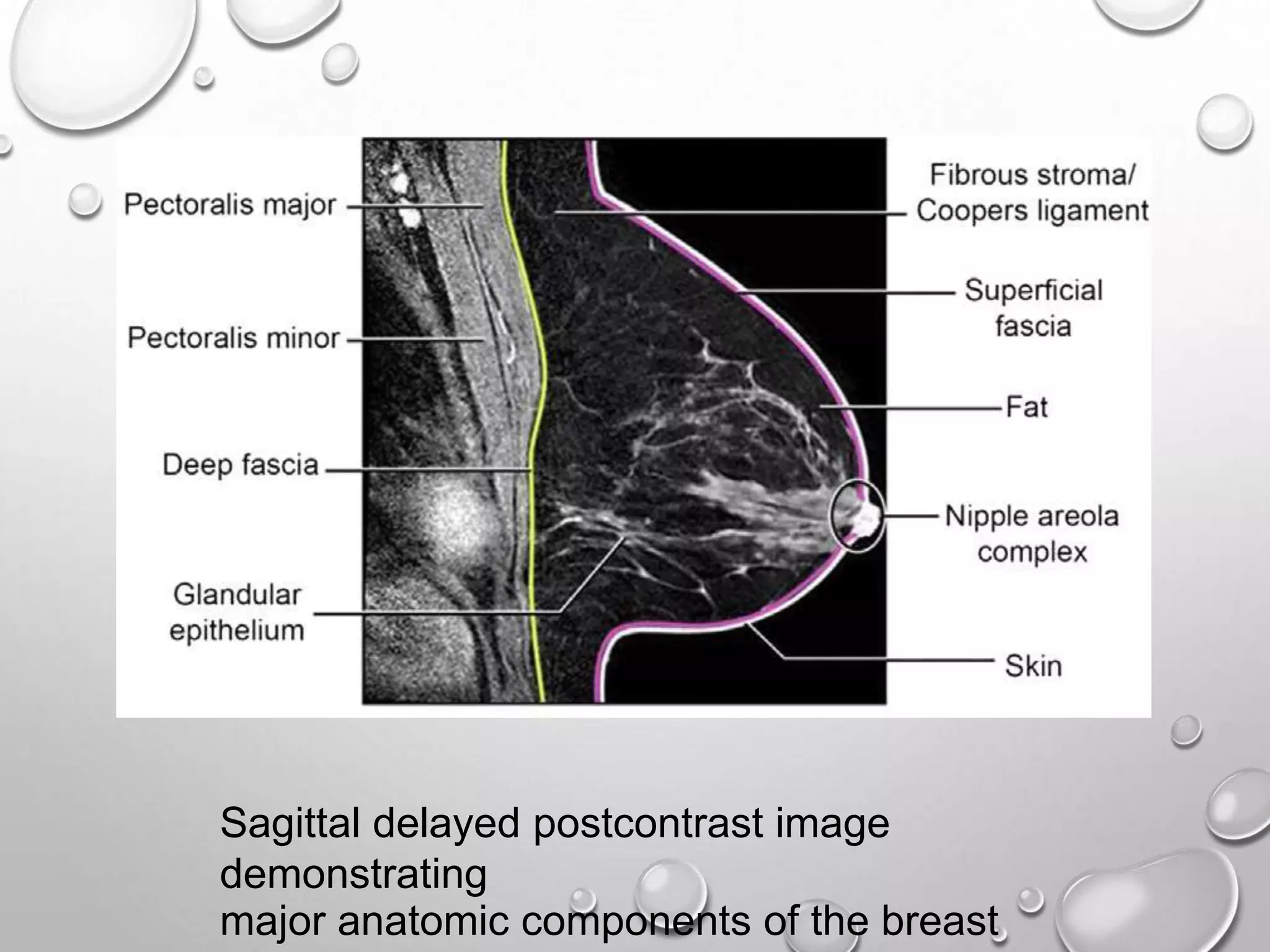 MRI BREAST PPT | PPTX