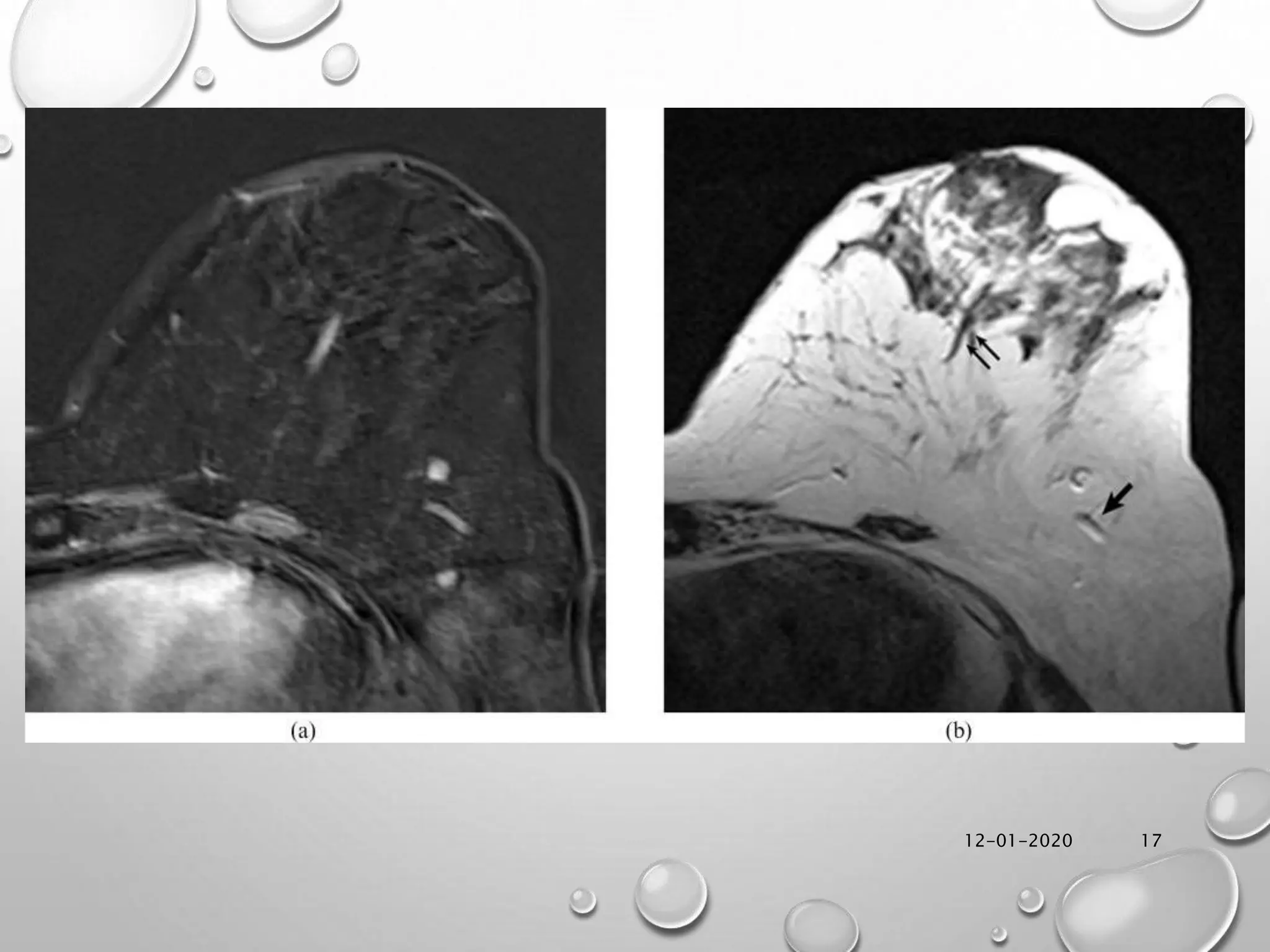 MRI BREAST PPT | PPTX
