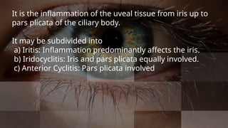 Anterior Uvietis mbbs powerpoint presentation | PPTX