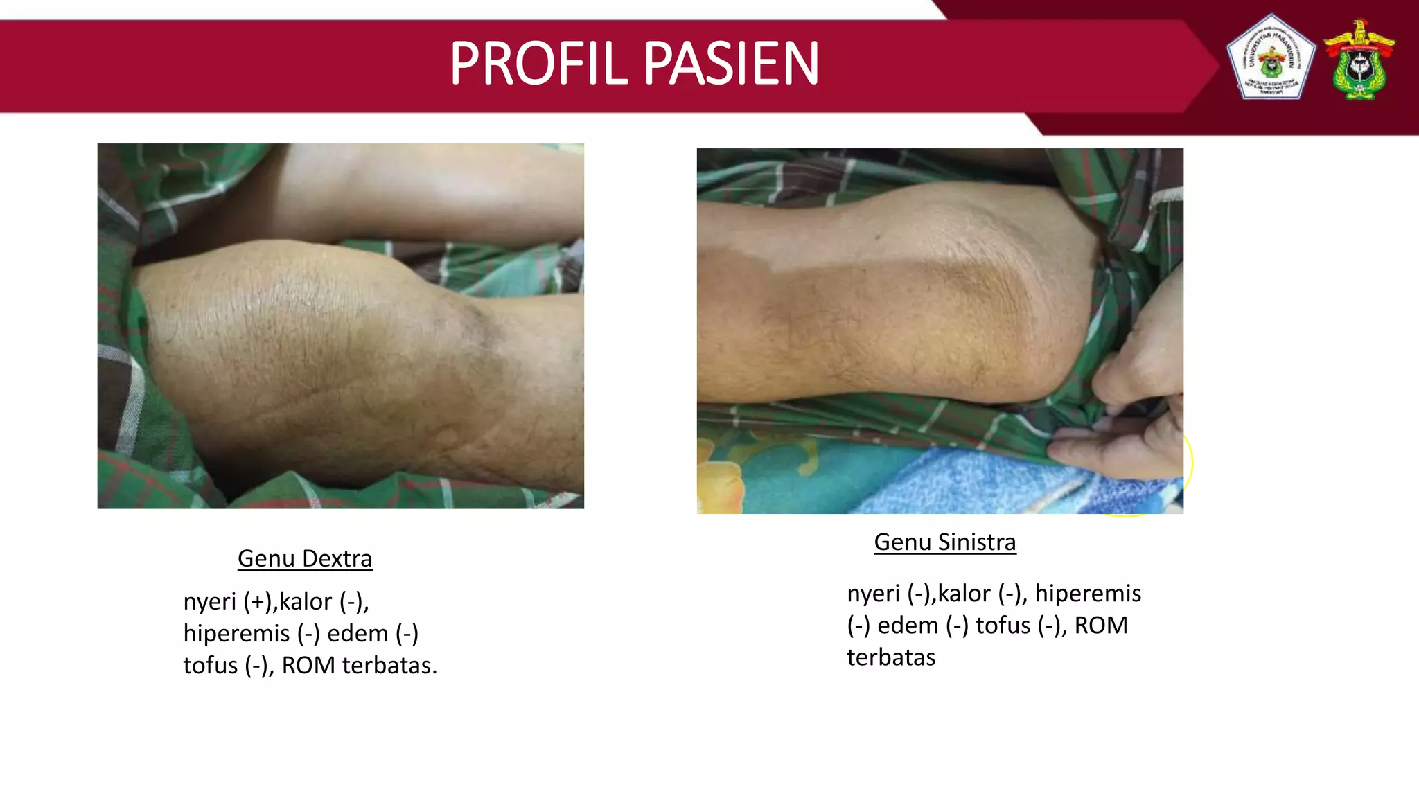 MR 4 Periode maret arthritis gout akut.pptx