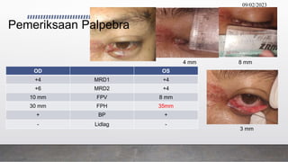 Morning report presentation ophthalmology cases | PPTX