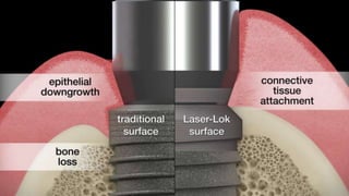 Biohorizons Implant System Overview | PPTX
