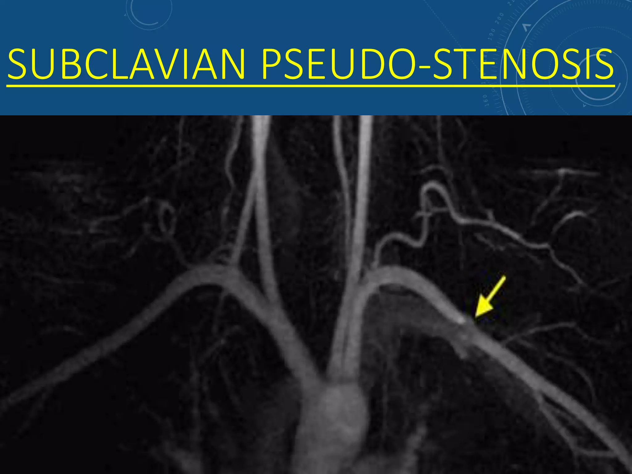 Magnetic Resonance Angiography and techniques | PPTX