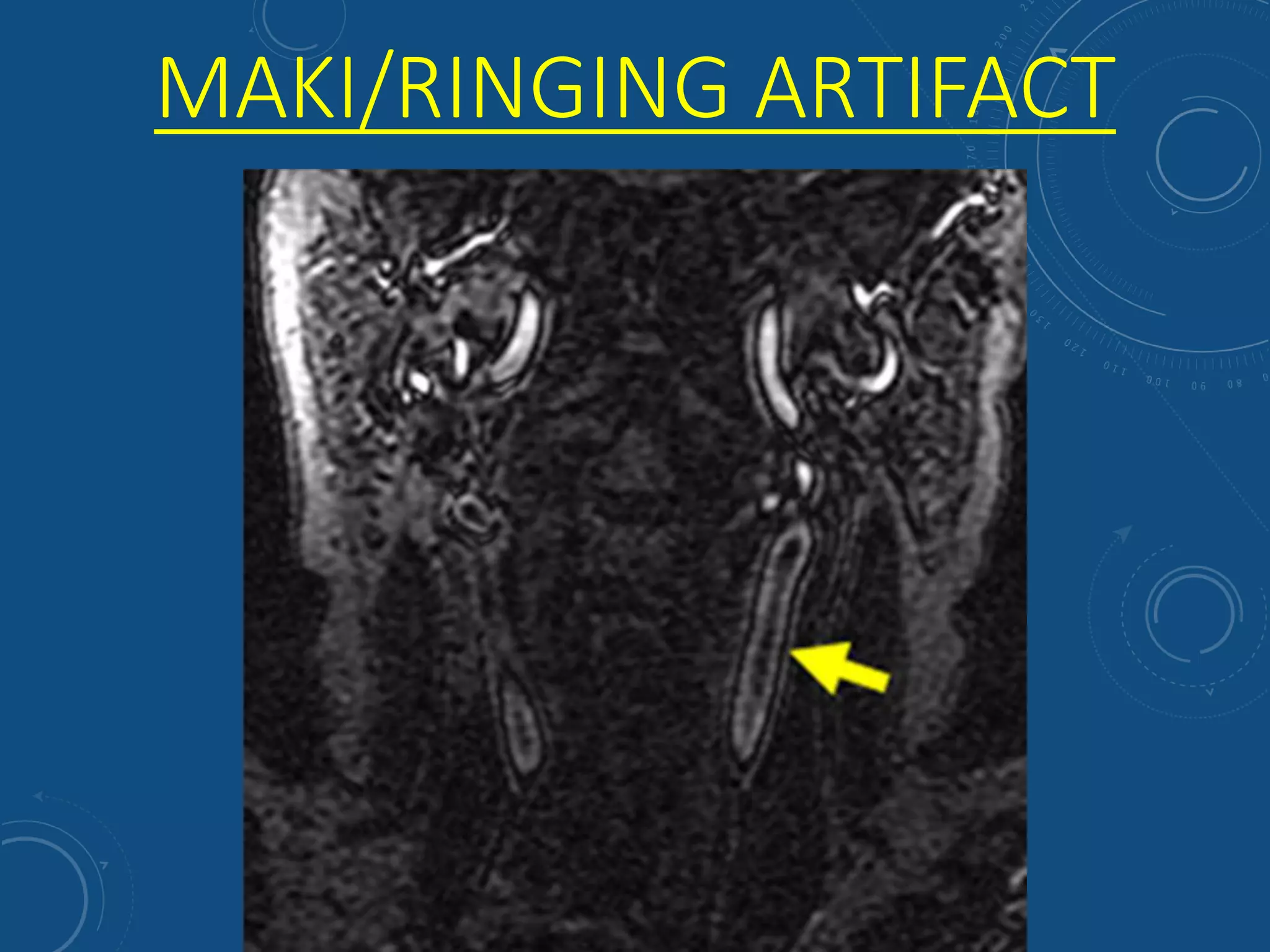 Magnetic Resonance Angiography and techniques | PPTX