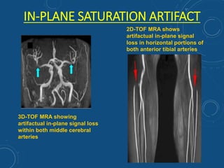 Magnetic Resonance Angiography and techniques | PPT