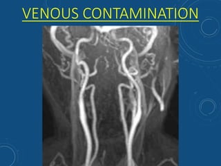 Magnetic Resonance Angiography and techniques | PPTX