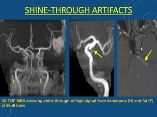 Magnetic Resonance Angiography and techniques | PPTX