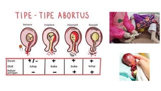 MR abortus incomplete adalah keguguran dibawah 20 minggu | PPTX