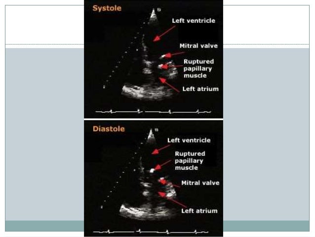 Normal Lv Size With Hyperdynamic Systolic Function | Paul Smith