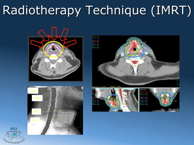 Radiation therapy for laryngeal function preservation by Brian O ...