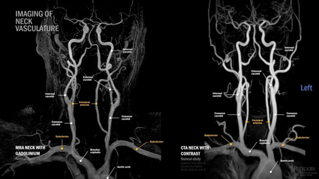 Magnetic Resonance Angiography of head and neck.pptx